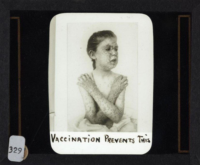 Our Revolutionary War on Smallpox: Lockdowns and Mass Inoculations ...