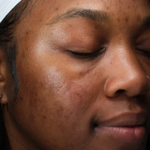 Laser Skin Resurfacing & Facial Rejuvenation - SKIN LAUNDRY