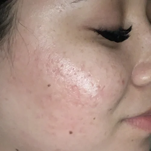 Laser Skin Resurfacing & Facial Rejuvenation - SKIN LAUNDRY