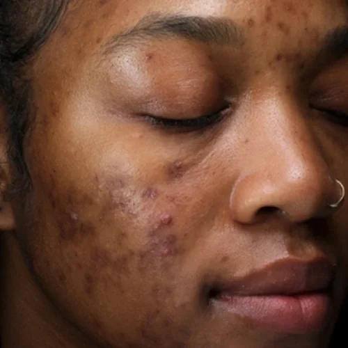 Skin Laundry | Resurfacing Facial