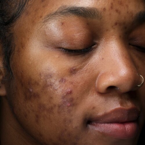 Laser Skin Resurfacing & Facial Rejuvenation - SKIN LAUNDRY