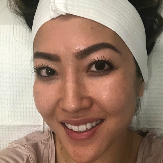 Laser Facial First Time Offer