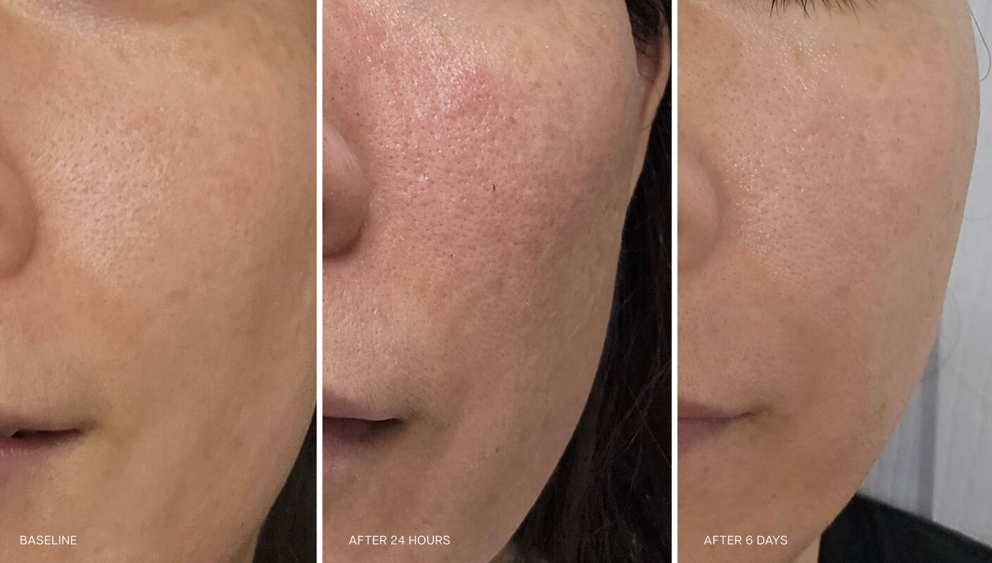 Learn About The Resurfacing Facial Treatment - Skin Laundry