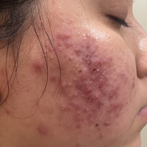 Laser Skin Resurfacing & Facial Rejuvenation - SKIN LAUNDRY