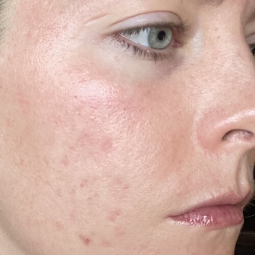 Laser Skin Resurfacing & Facial Rejuvenation - SKIN LAUNDRY