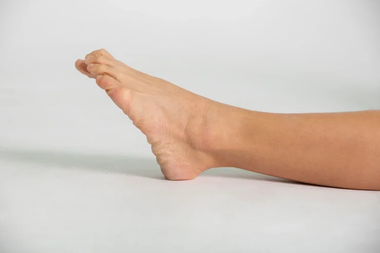 Edema Swelling: 6 Natural Ways to Reduce It (At Home) – NativePath