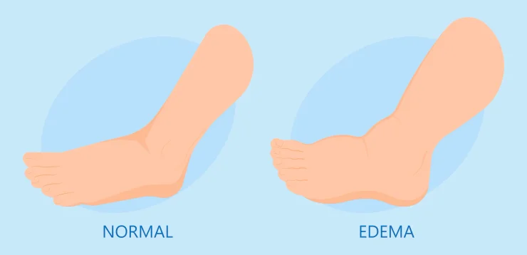 What Is Edema? Types, Symptoms, Causes, & Natural Treatments