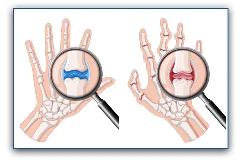 Bone-Dissolving Foods Seniors Must Avoid