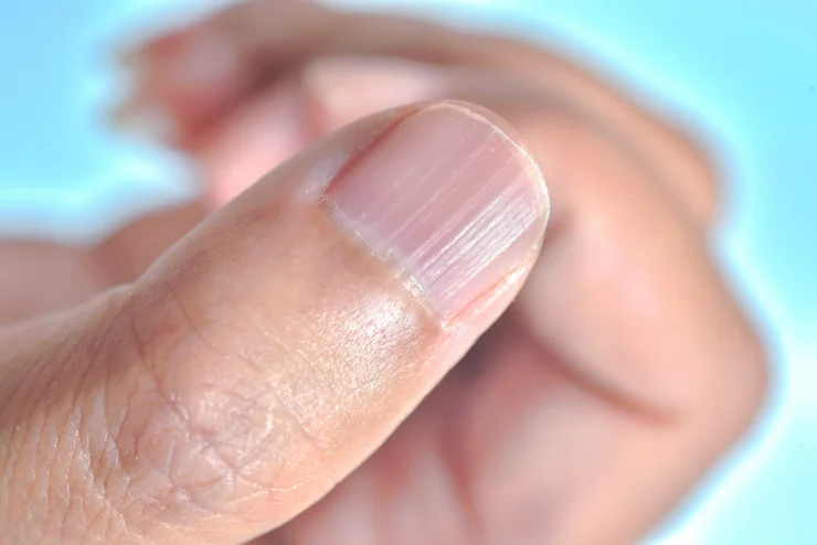 Vertical Ridges on Nails: Is It a Vitamin Deficiency?