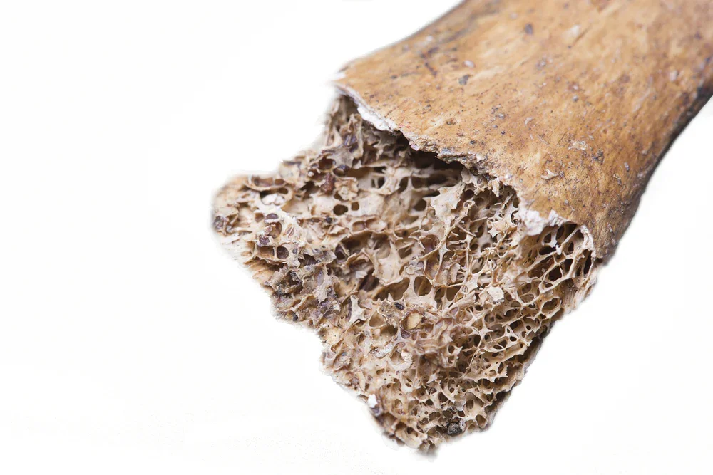 Bone-Dissolving Foods Seniors Must Avoid