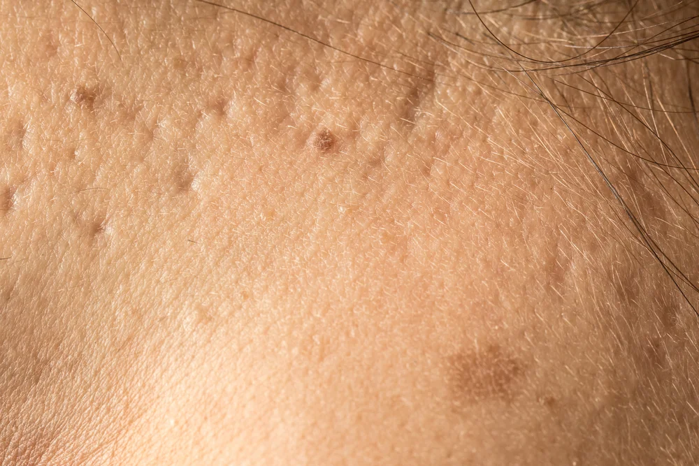 What Are Pock Marks? | Blog