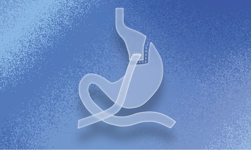 Individuell abgestimmte Nahrungsergänzungsmittel für bariatrische ...