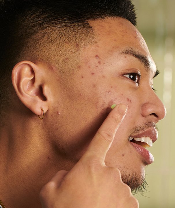 Tahapan Skincare Untuk Kulit Berjerawat